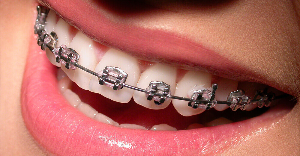 Vaste beugel - Orthodontie Museumplein